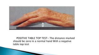 Dupuytren disease | PPTX