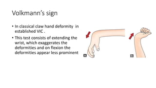 Volksman ischemic Contracture orthopaedics .pptx