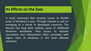 Measles and the eye.pptx