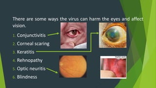 Measles and the eye.pptx