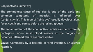 Measles and the eye.pptx
