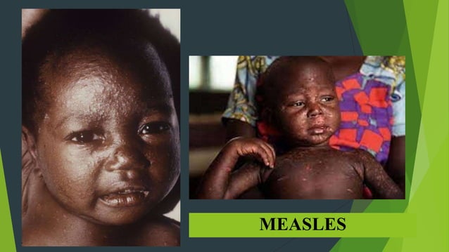 Measles and the eye.pptx