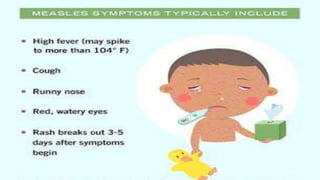 Measles and the eye.pptx