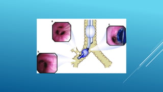 Video-assisted thoracic surgery (VATS) | PPTX