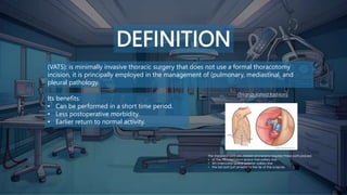 Video-assisted thoracic surgery (VATS).pptx