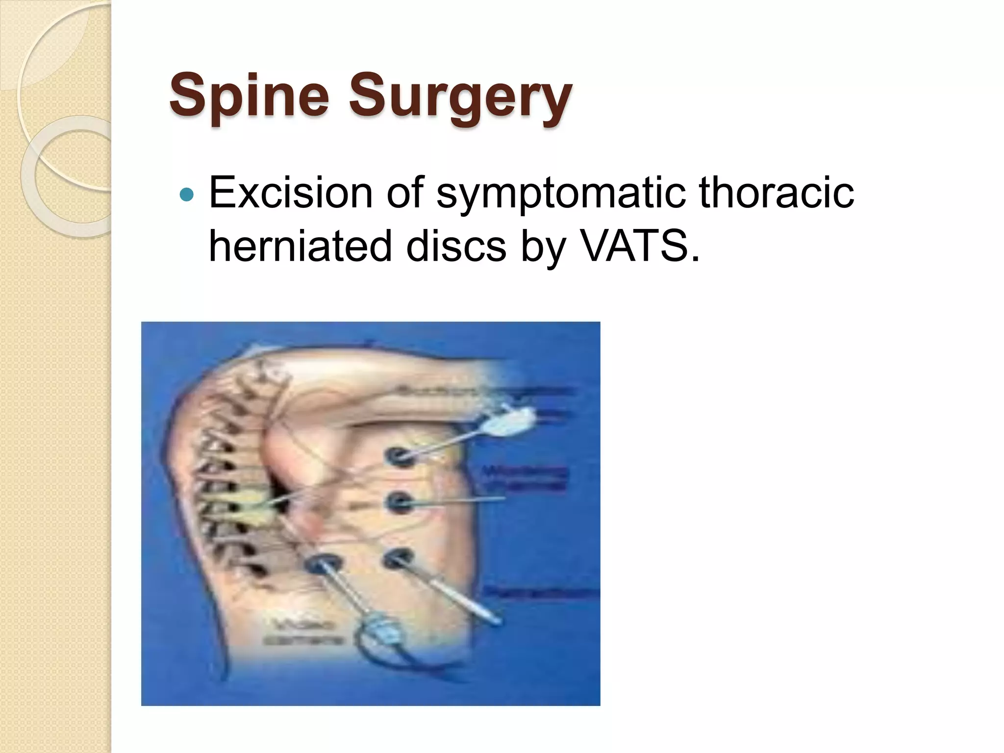 Video assisted thoracic surgery | PPTX