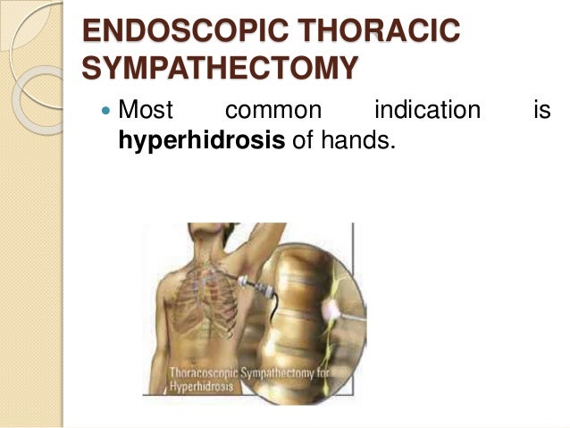 Video assisted thoracic surgery