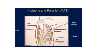Video assisted thoracic surgery | PPTX