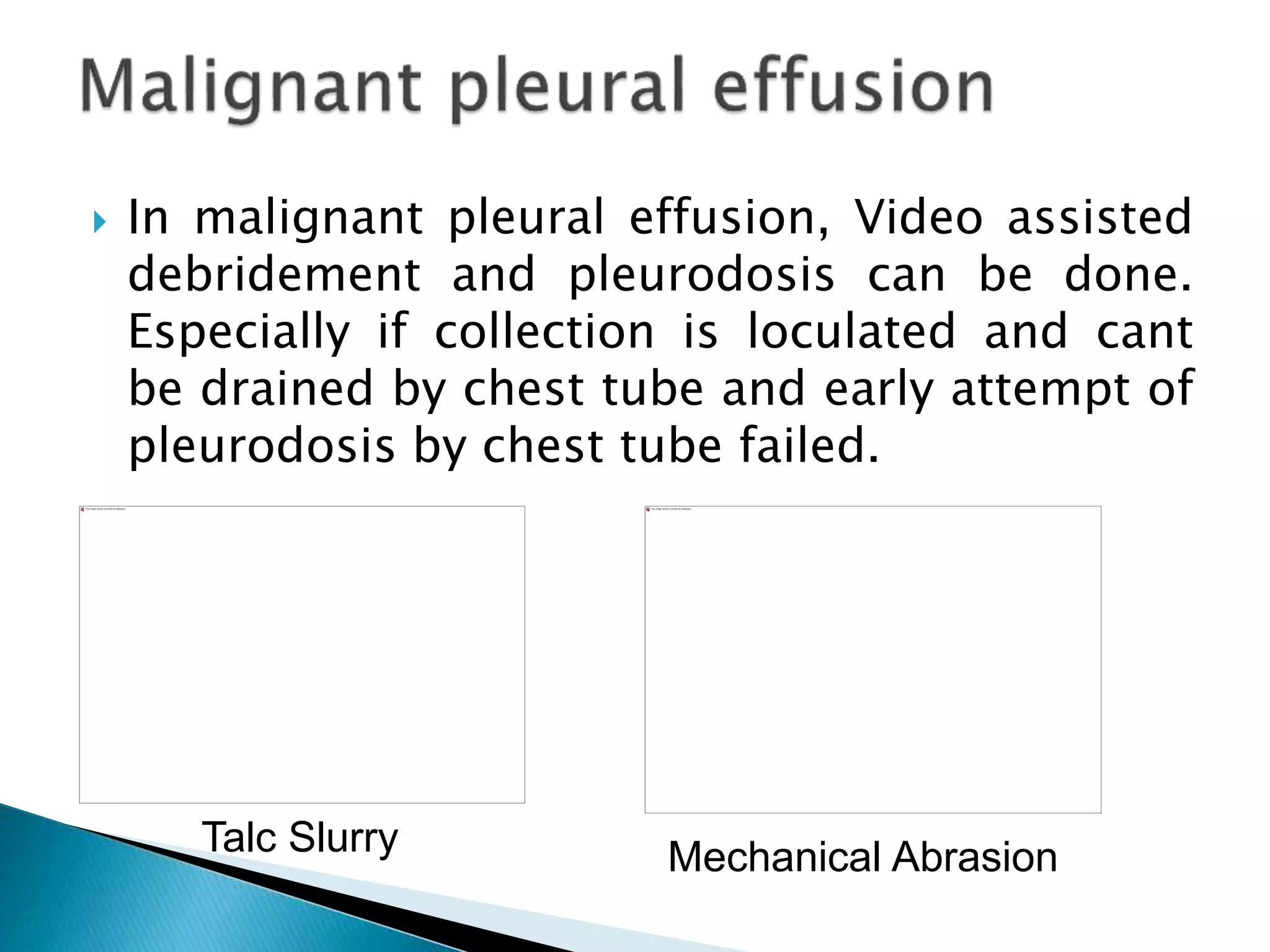 Video assisted thoracic surgery (vats) | PPTX
