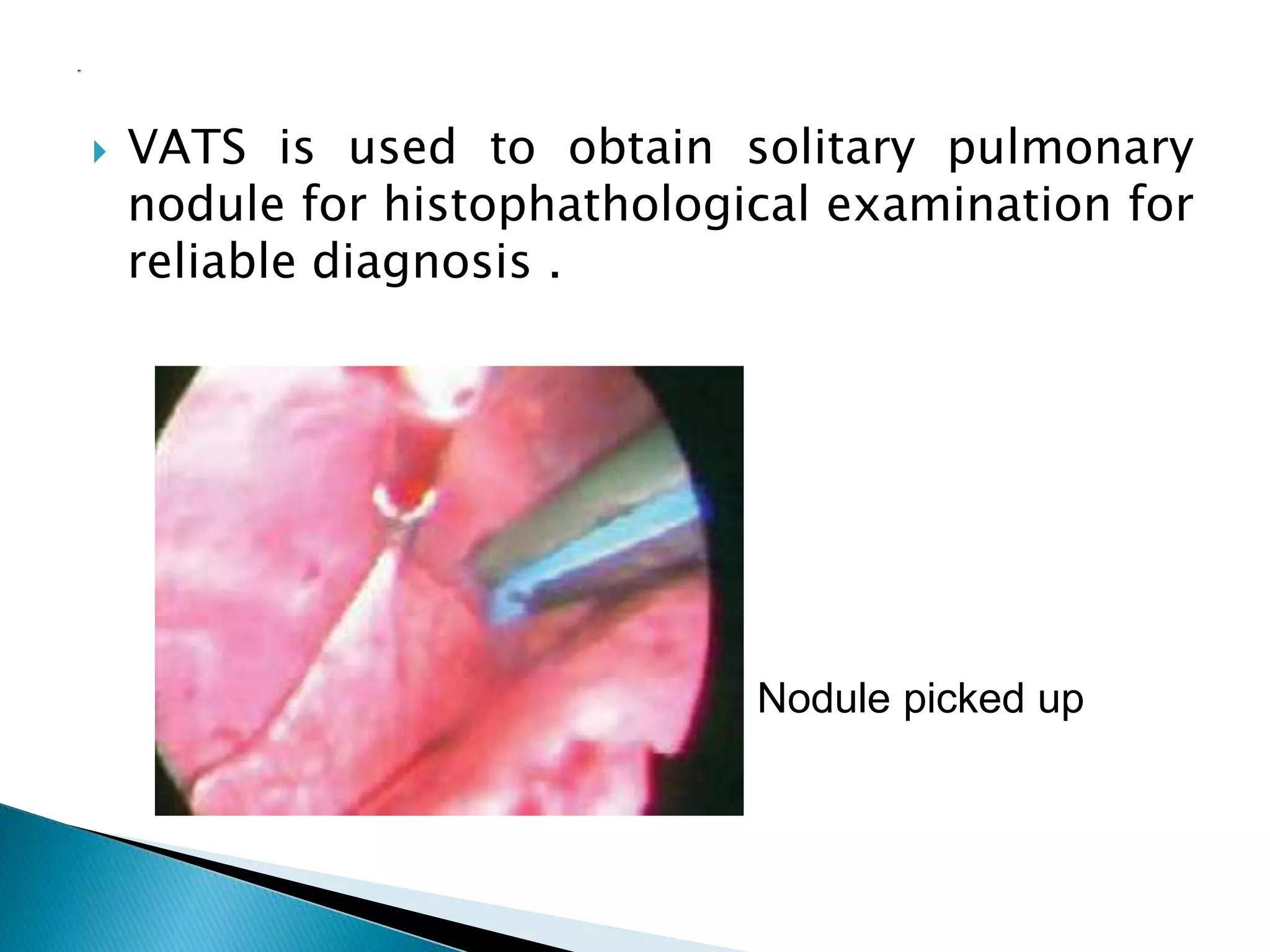 Video assisted thoracic surgery (vats) | PPTX