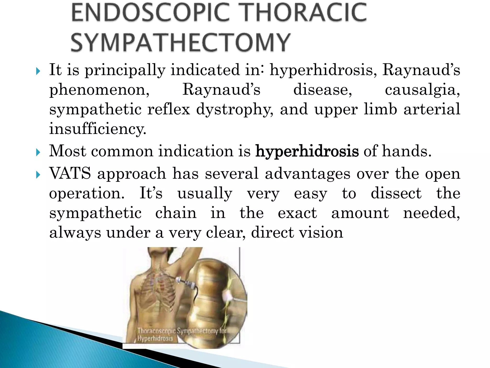 Video assisted thoracic surgery (vats) | PPTX