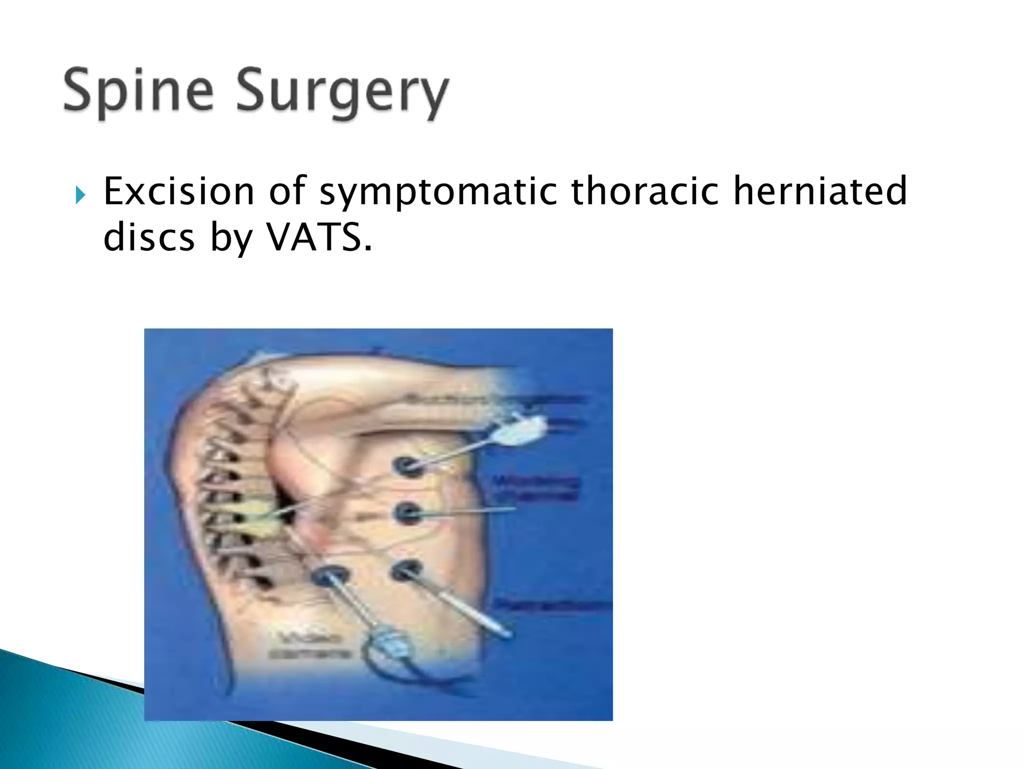 Video assisted thoracic surgery (vats) | PPTX