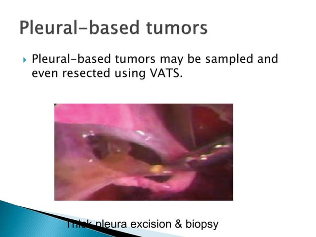 Video assisted thoracic surgery (vats) | PPTX | Lung and Respiratory ...