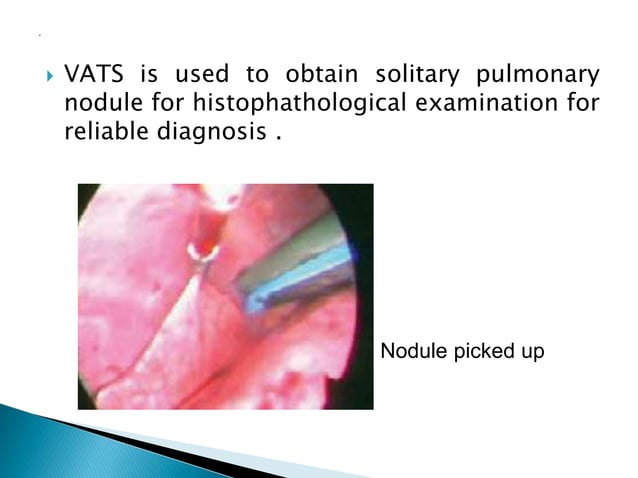 Video assisted thoracic surgery (vats) | PPTX | Lung and Respiratory ...