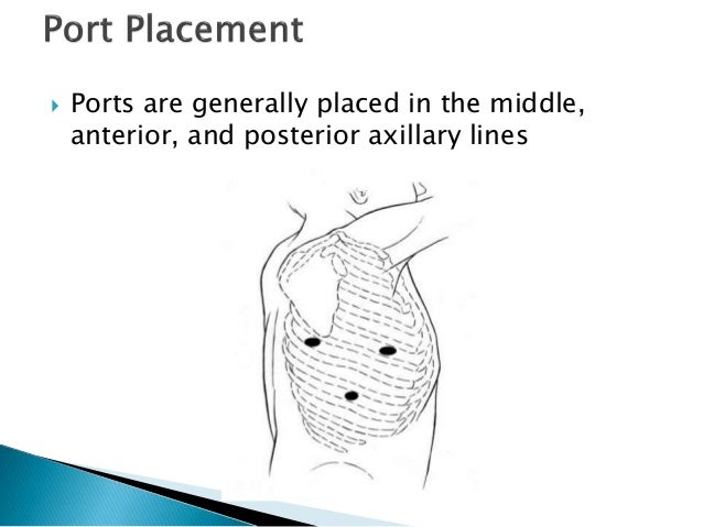 Video assisted thoracic surgery (vats)