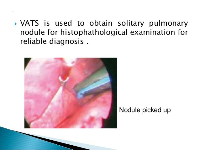 Video assisted thoracic surgery (vats)