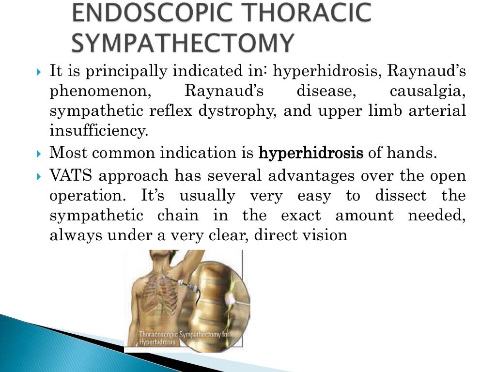 Video assisted thoracic surgery (vats)