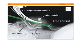 introduction to videolaryngoscope for anaesthesia technicians | PPTX