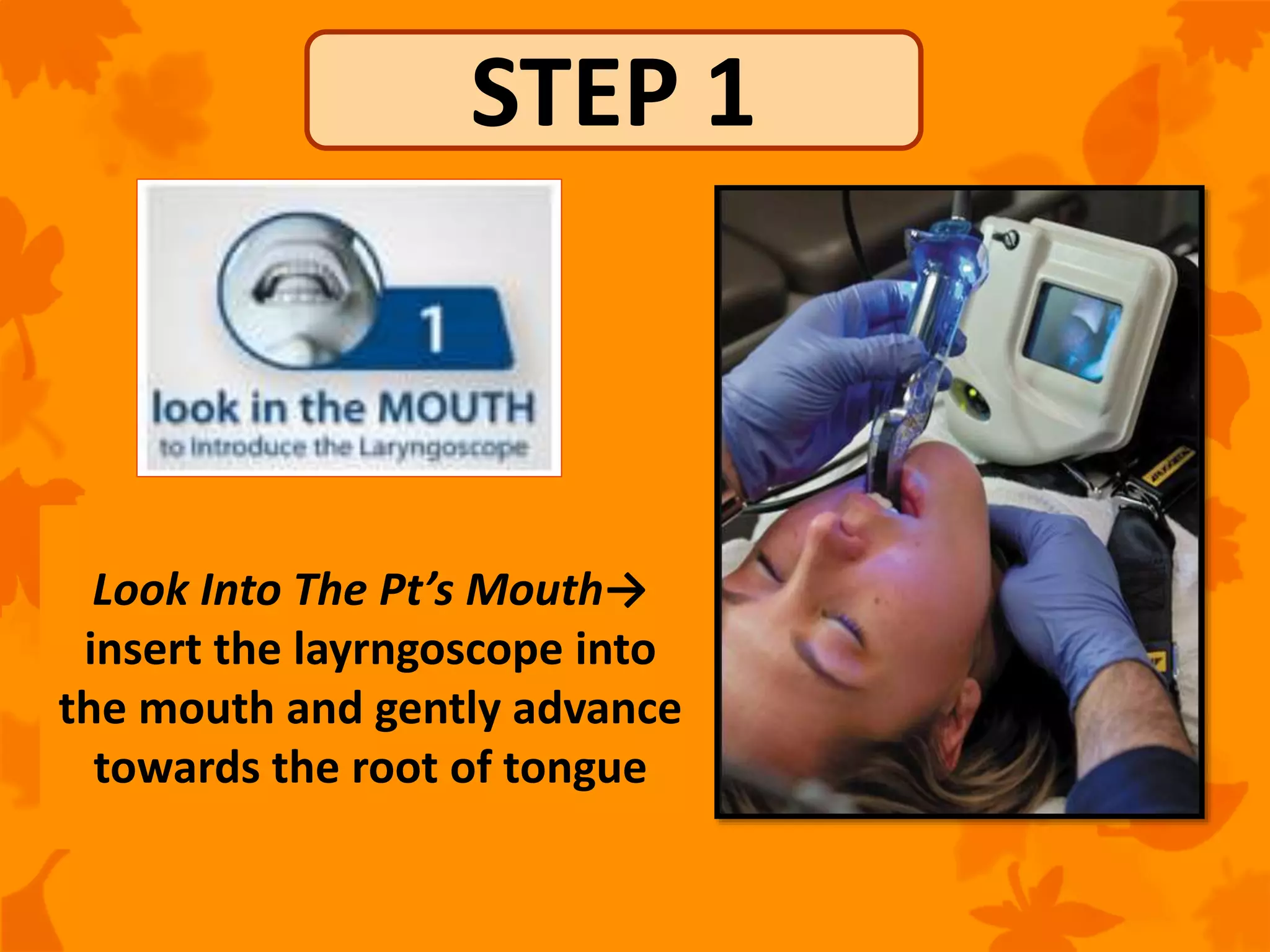 Videolaryngoscopes for tracheal intubation | PPTX