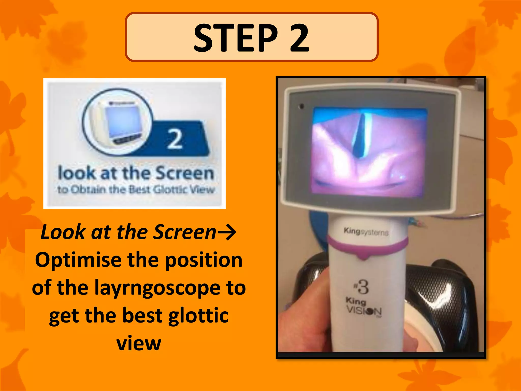 Videolaryngoscopes for tracheal intubation | PPTX