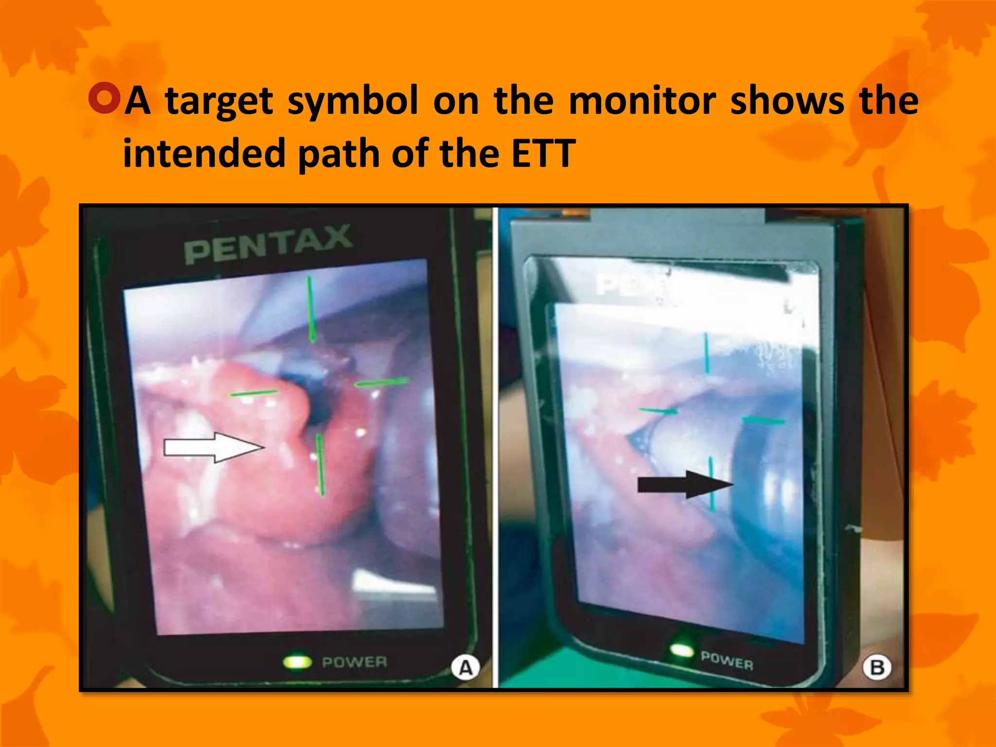 Videolaryngoscopes for tracheal intubation | PPTX