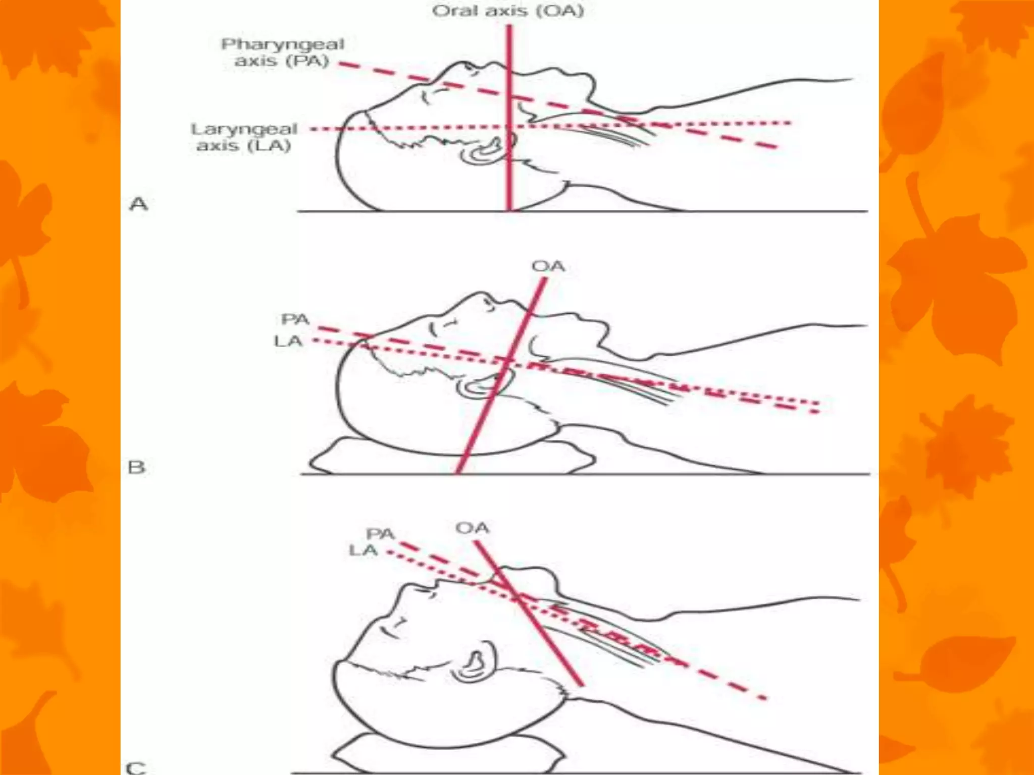 Videolaryngoscopes for tracheal intubation | PPTX