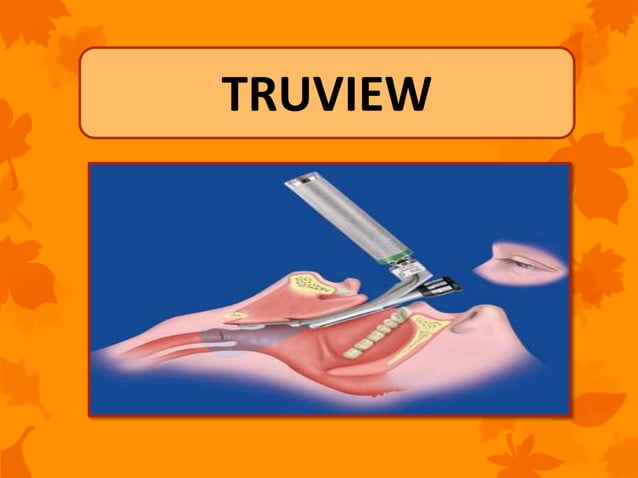 Videolaryngoscopes for tracheal intubation | PPTX | Ear, Nose and ...