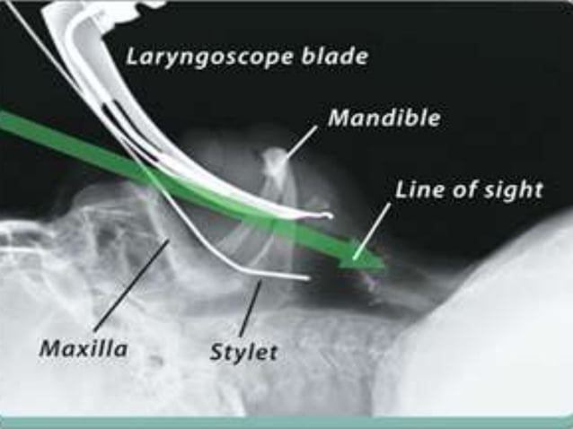 Videolaryngoscopes for tracheal intubation | PPTX | Ear, Nose and ...