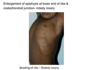 vitamin-d-first yr | PPTX
