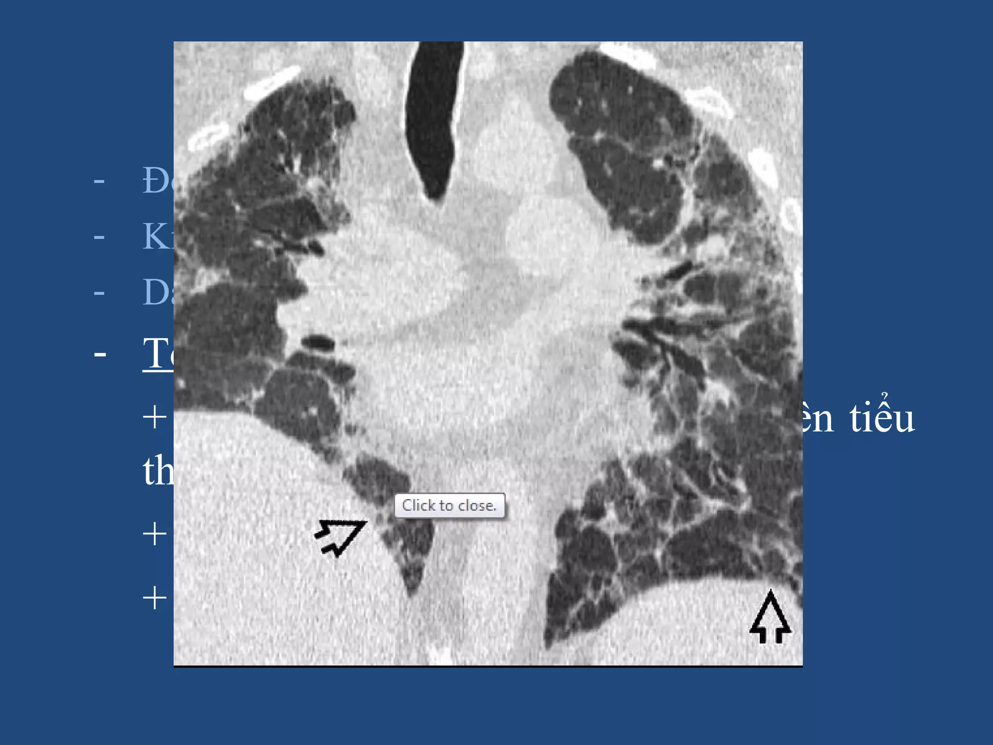 Viêm phổi tổ chức hóa | PPT