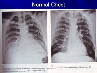 Viewing of the chest film | PPT