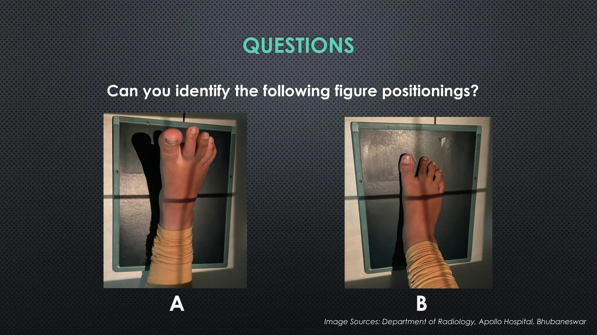 X-RAY views for foot, calcaneum, and ankle joint. | PDF