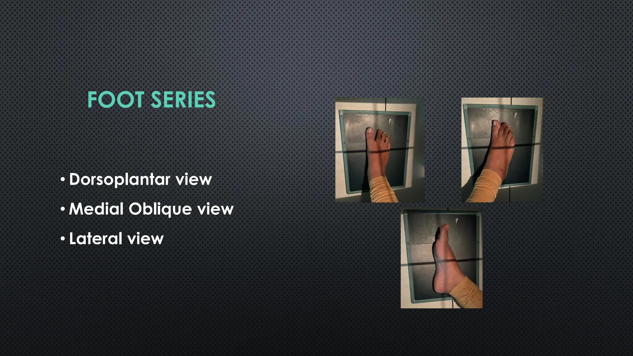 X-RAY views for foot, calcaneum, and ankle joint. | PDF