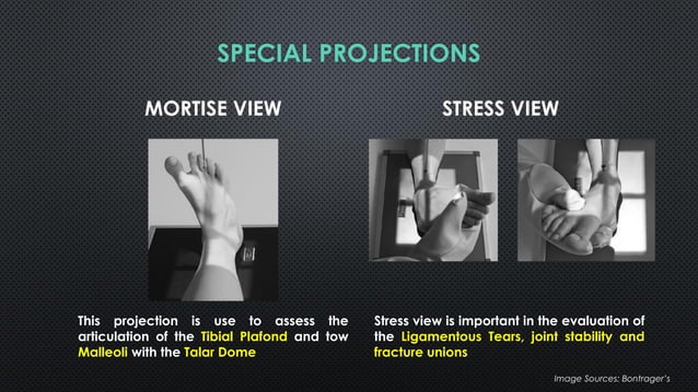 X-RAY views for foot, calcaneum, and ankle joint. | PDF