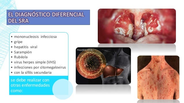 infección natural por el VIH