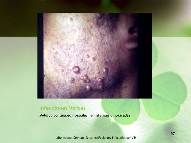 Vih y dermatosis | PPT