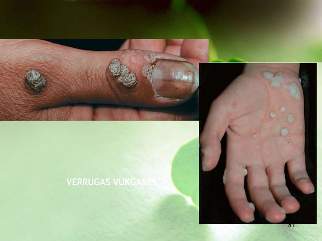 Vih y dermatosis | PPT