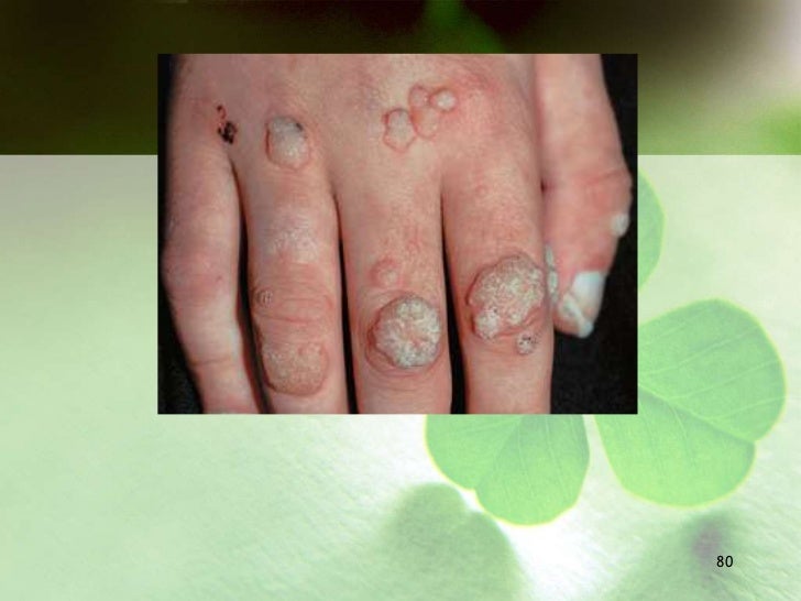 Vih y dermatosis