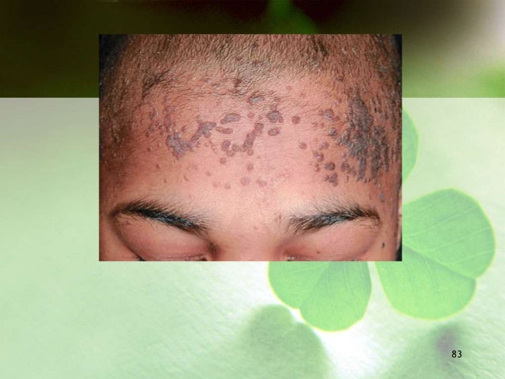 Vih y dermatosis