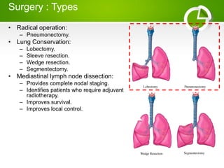 LUNG CANCER | PPTX