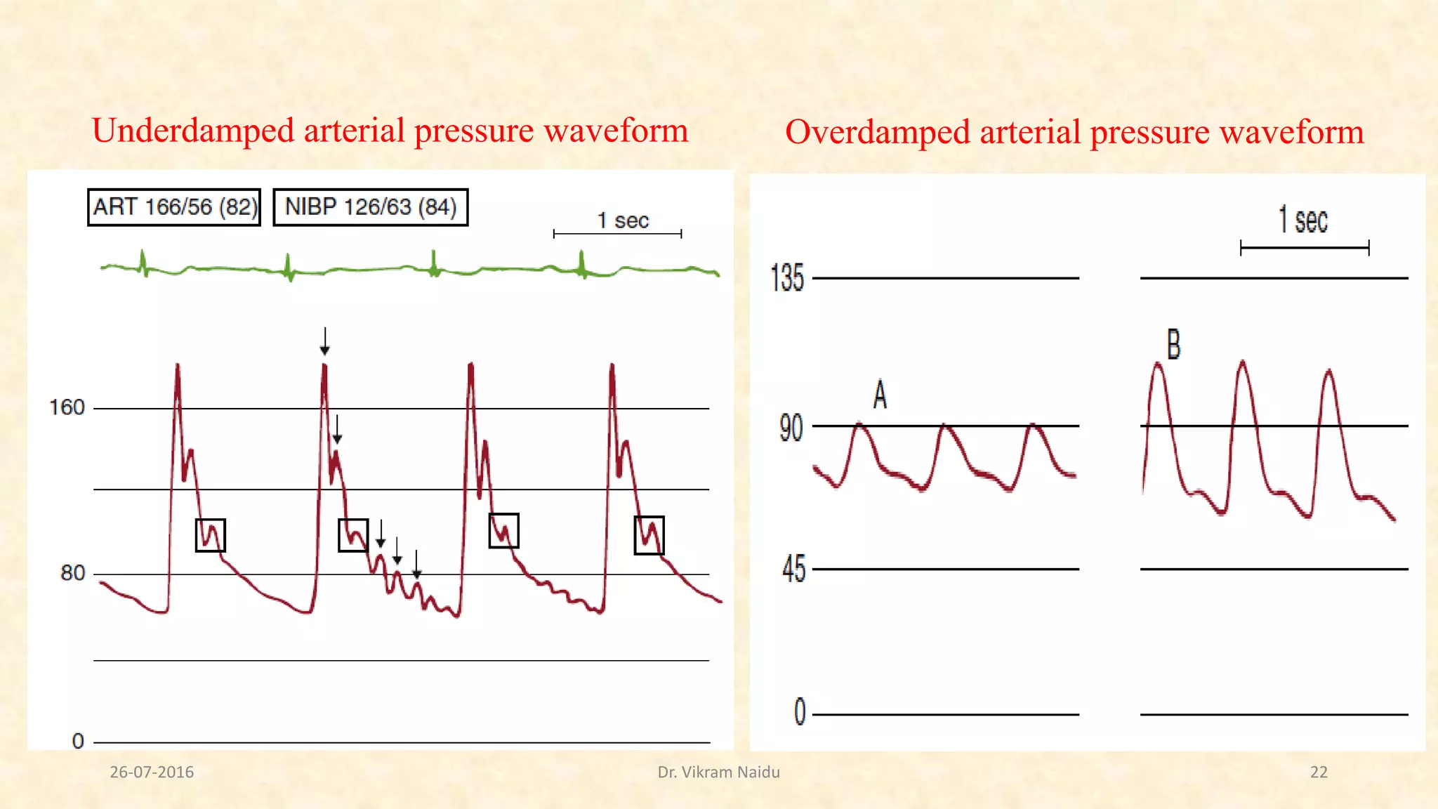 INTRA-ARTERIAL BLOOD PRESSURE MONITORING | PPTX