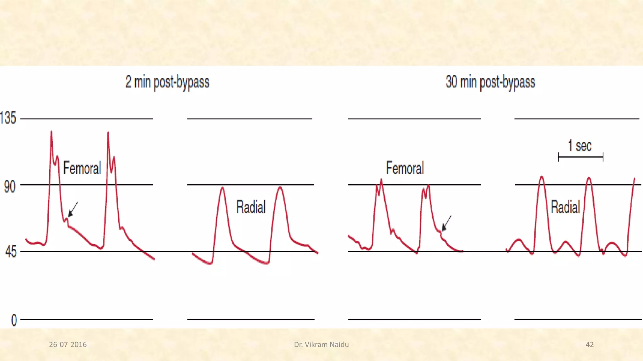 INTRA-ARTERIAL BLOOD PRESSURE MONITORING | PPTX