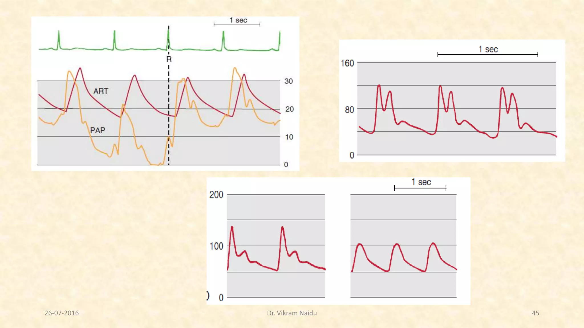 INTRA-ARTERIAL BLOOD PRESSURE MONITORING | PPTX