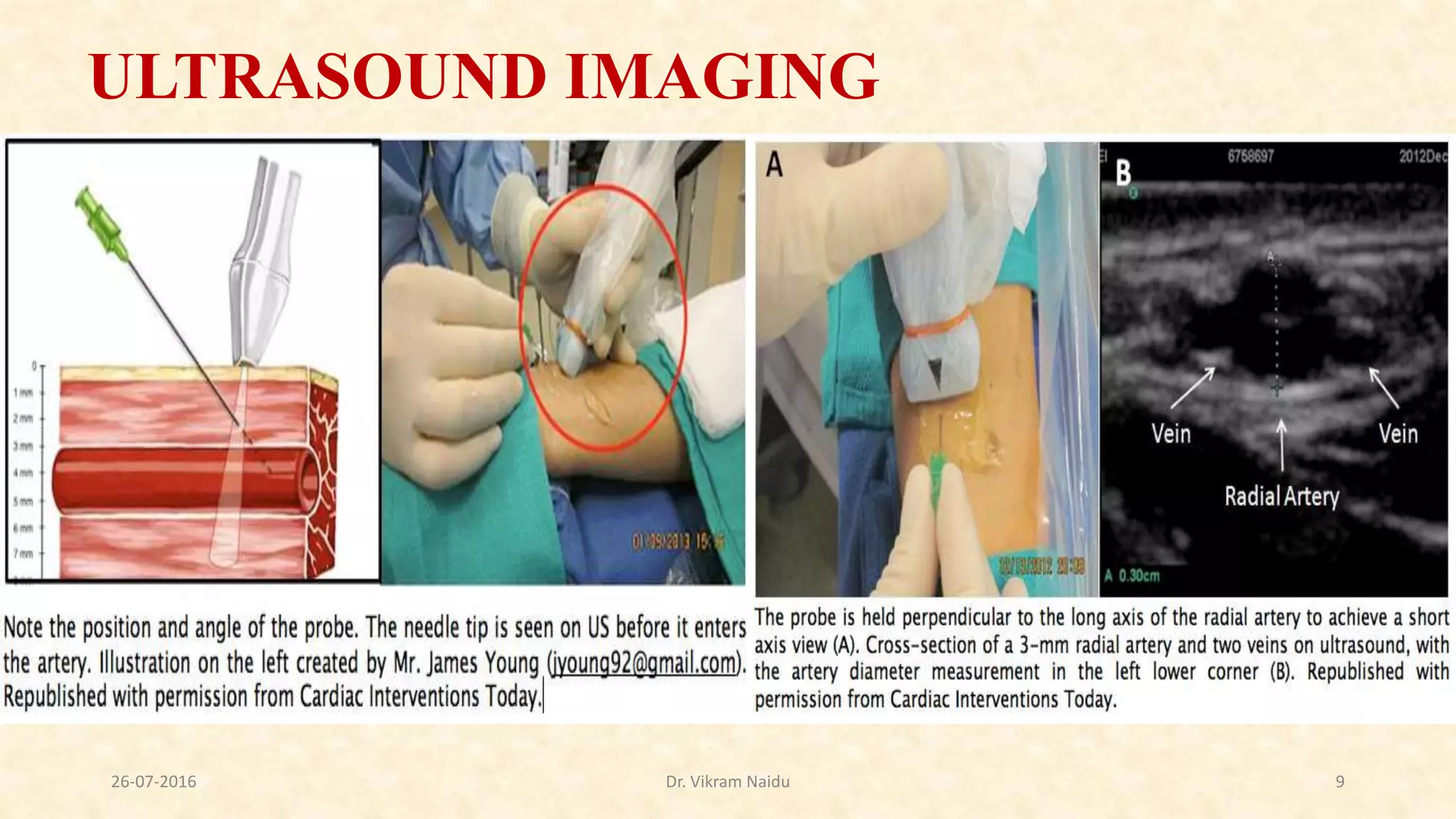 INTRA-ARTERIAL BLOOD PRESSURE MONITORING | PPTX