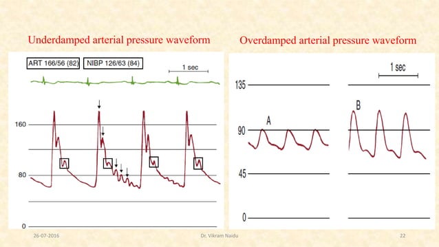 INTRA-ARTERIAL BLOOD PRESSURE MONITORING | PPTX