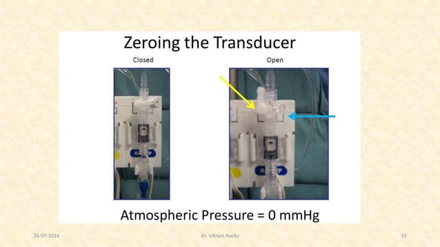 INTRA-ARTERIAL BLOOD PRESSURE MONITORING | PPTX
