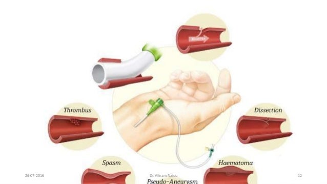 intra-arterial-blood-pressure-monitoring