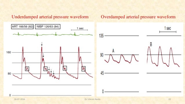 INTRA-ARTERIAL BLOOD PRESSURE MONITORING