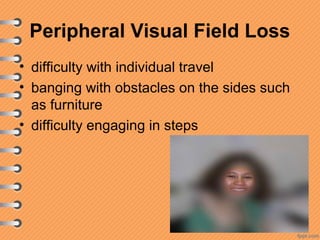 understanding visual impairment | PPT