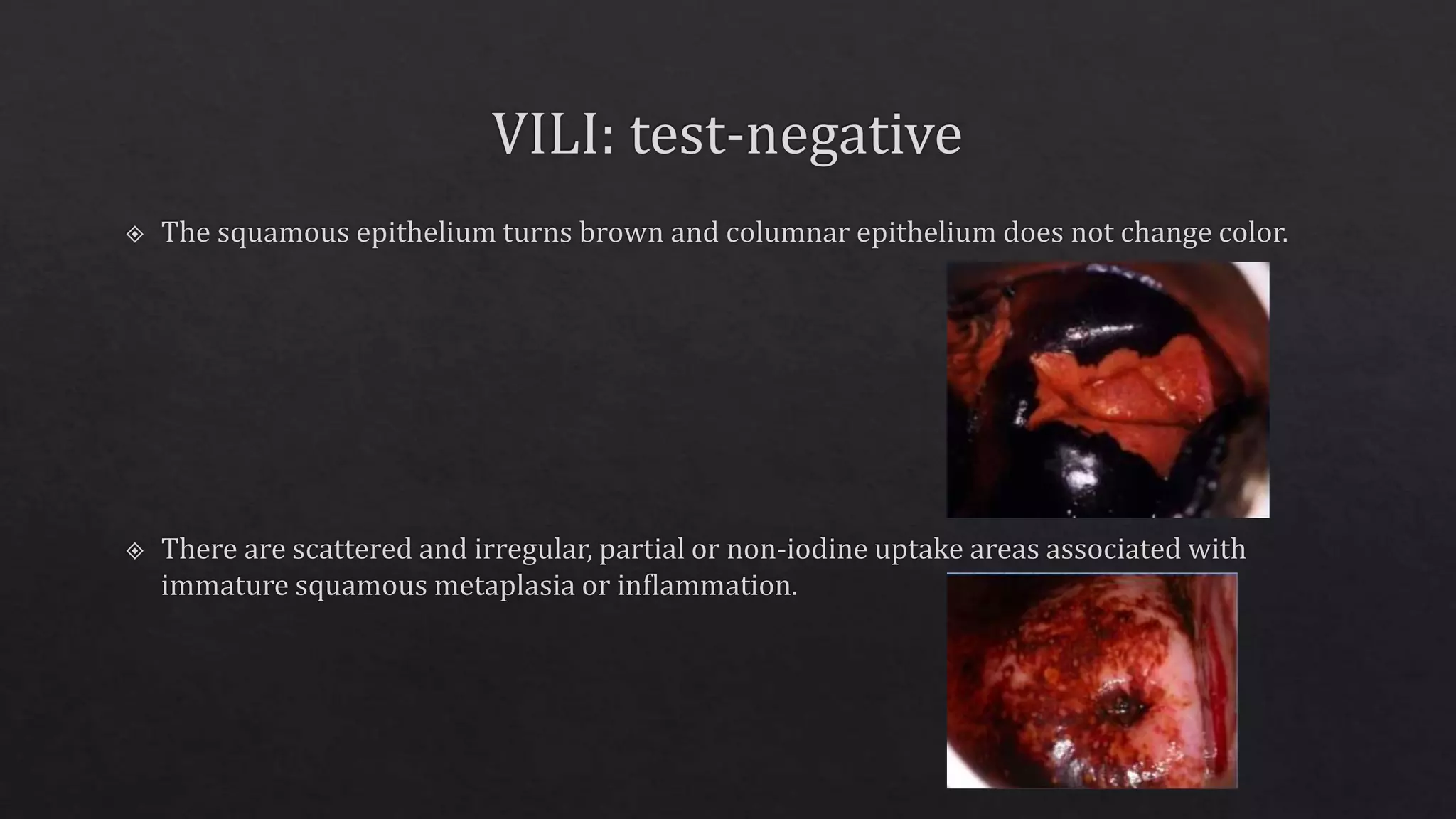 Vili ( Visual inspection lugol's iodine) | PPT